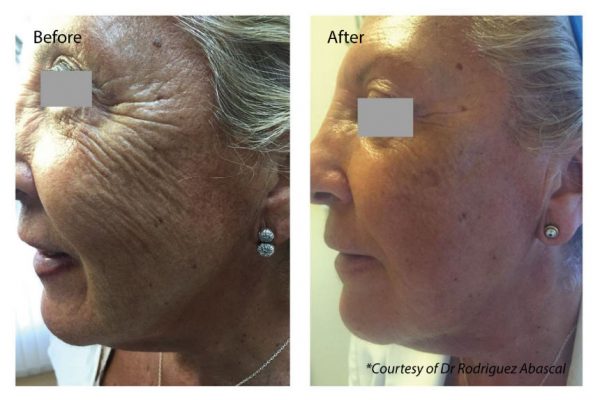 Profhilo - KHD Aesthetics – Skin & Aesthetic Clinic in Birmingham